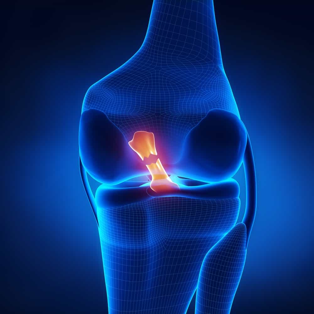 What is Anterior Cruciate Ligament (ACL) Injury? (Symptoms & Reasons)