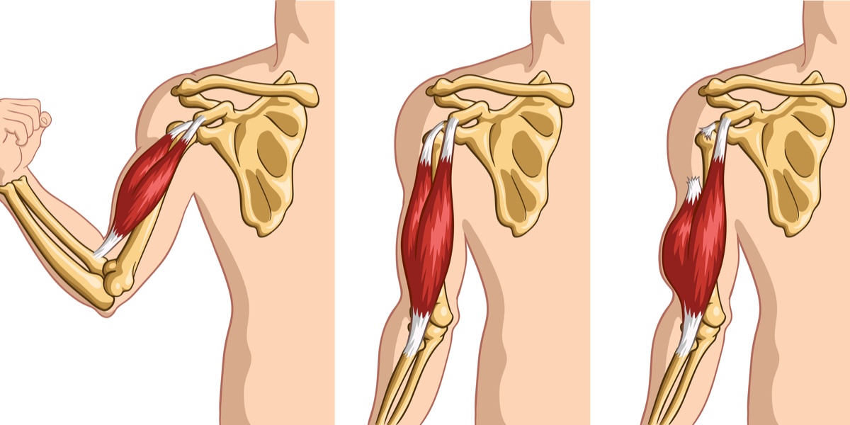 Torn Biceps: Prevention and Treatment