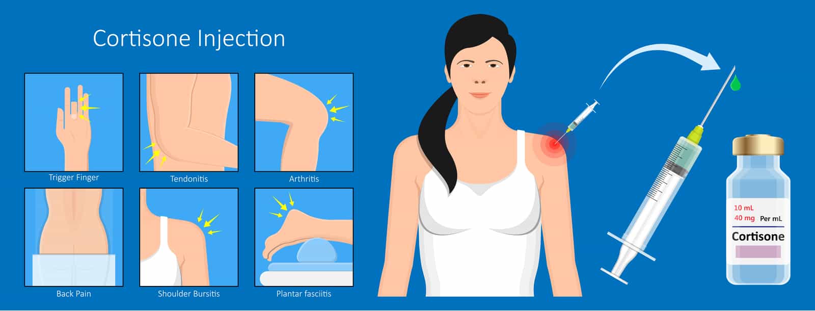 Cortisone Injections vs Viscosupplementation: Indications, Benefits ...