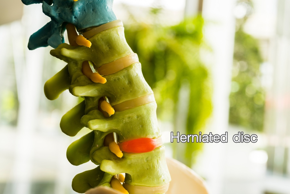 Common Causes and Risk Factors of a Herniated Disc