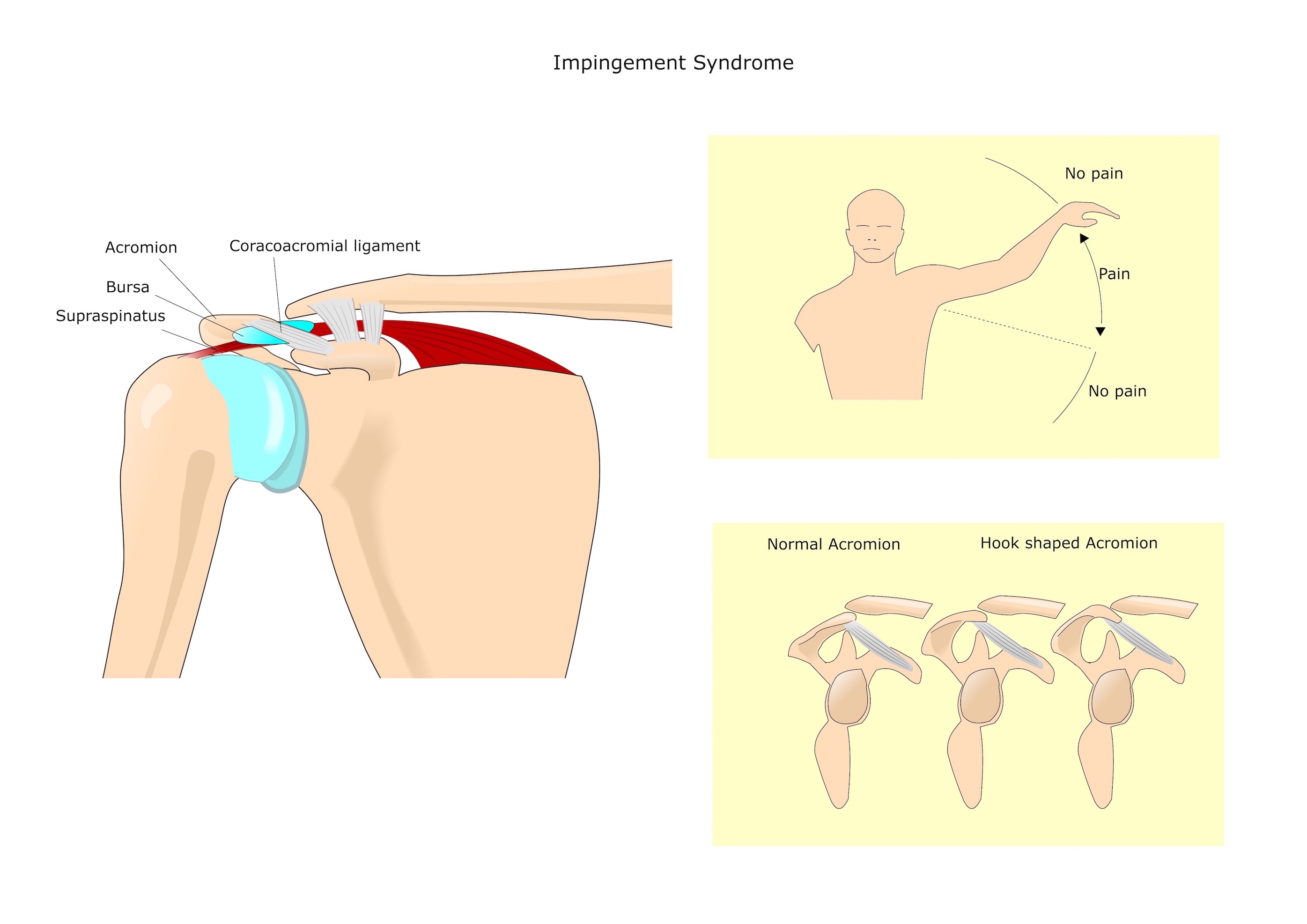 What is SHOULDER IMPINGEMENT SYNDROME Signs Symptoms Treatments