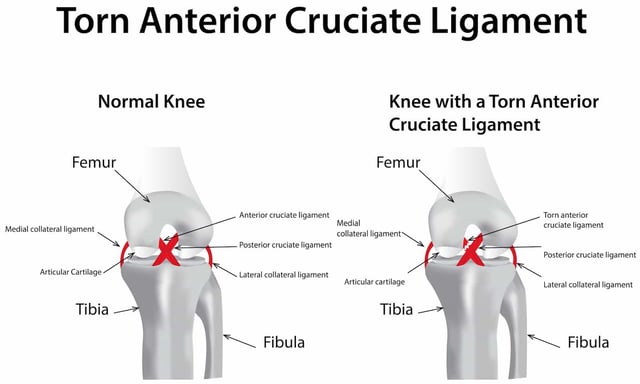 What is Anterior Cruciate Ligament (ACL) Injury? (Symptoms & Reasons)